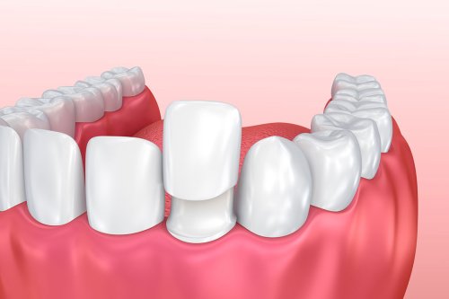 How Do Dental Veneers Work? - Emerson Dental